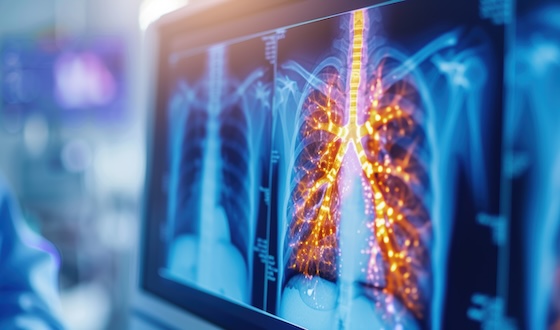 AirNexis debuts with $200M in funding to develop China-sourced COPD therapy