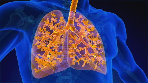 New data could make Insmed's MAC lung disease drug a frontline contender