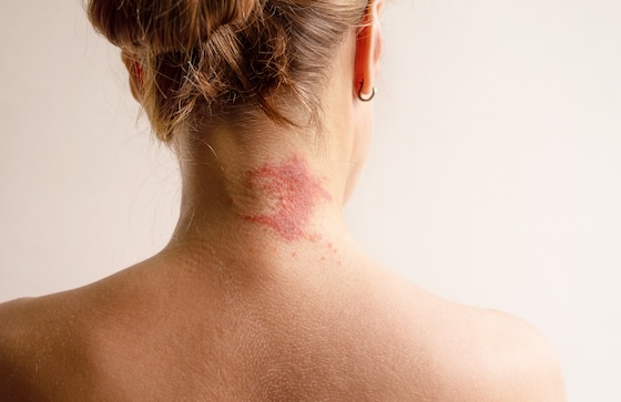 Nektar touts 'deepening clinical effect' of IL-2 agonist in atopic ...