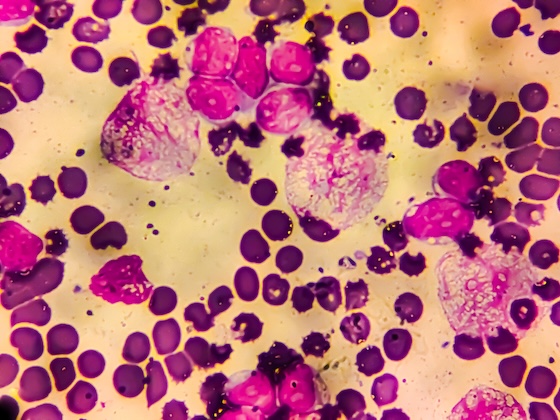 Flatiron Health adds Adaptive Biotechnologies’ MRD test to electronic ...