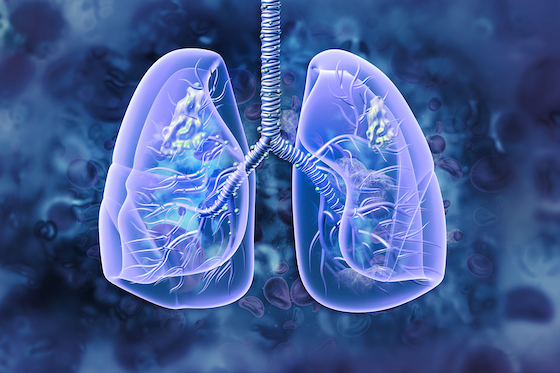 Roche lands FDA breakthrough tag for AI-driven lung cancer companion ...