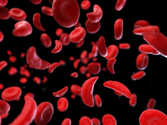 Pfizer's sickle cell woes continue with late-stage failure of inclacumab